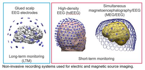 Source Imaging Of Epileptic Activity Universitätsklinikum Freiburg