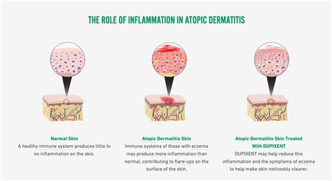 Everything You Need To Know About Dupixent Cottonique Allergy Free Apparel