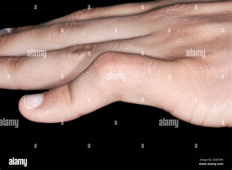 Deformity Following Dislocated Finger Fixed Flexion Deformity Of The Proximal Interphalangeal