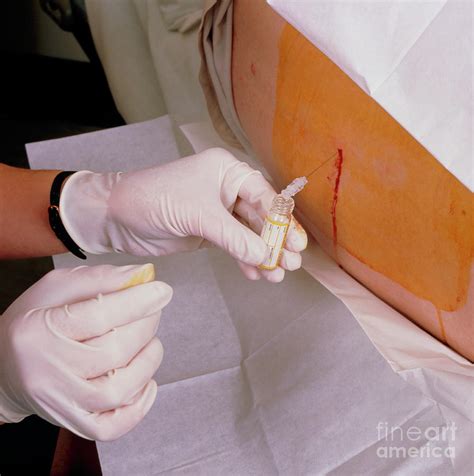 Lumbar Puncture Taking A Sample Of Spinal Fluid Photograph By Simon