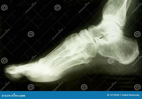 Tibia X Ray Picture Royalty Free Stock Image 19208884