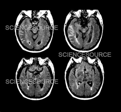 Composite Mri Of Subarachnoid Bleed Stock Image Science Source Images
