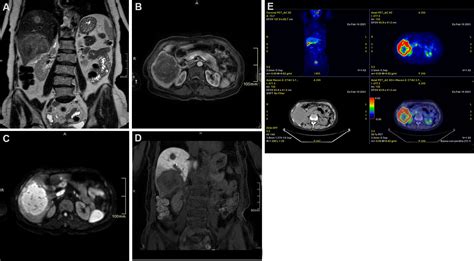 Radiological Imaging And Non Surgical Local Treatments For Cholangiocarcinoma