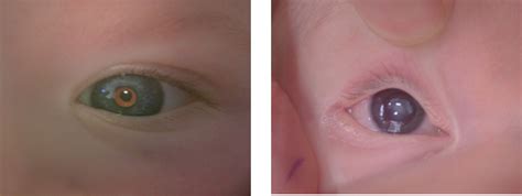 Newborn And Infant Physical Examination Nipe Screening Programme