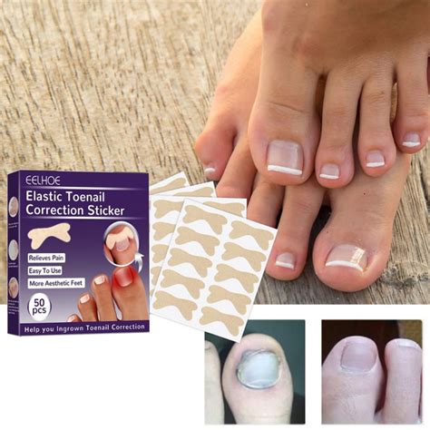 Набор пластырей Elastic Toenail Correction Sticker для безболезненной коррекции вросших ногтей