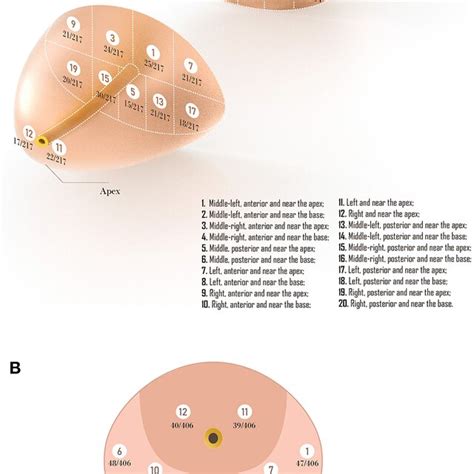 A Representative Trans Perineal Template Guided Mapping Biopsy Download Scientific Diagram