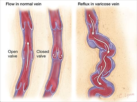 Management Of Varicose Veins And Venous Insufficiency Dermatology
