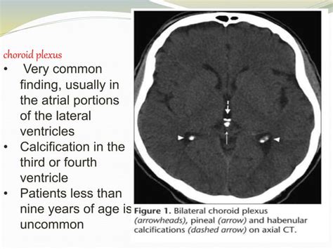 Physiological And Pathological Calcification Of Brain Pptx