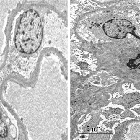 Electron Microscopy Extensive Effacement Of Podocyte Foot Processes Download Scientific