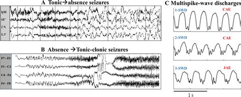 Absence Seizure Eeg