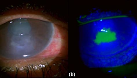 Persistent Epithelial Defect Md Searchlight