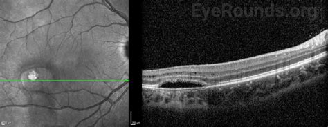 File Eyerounds Case 351 Fig2 Spectralis Oct Macula Rpe Od Lrg  Nc Commons