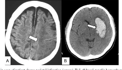 Stroke Ct Scan Stroke Ct Scan