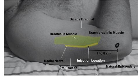 Figure 1 From Radial Nerve Supracondylar Block Versus Fracture Hematoma Block Comparison Of