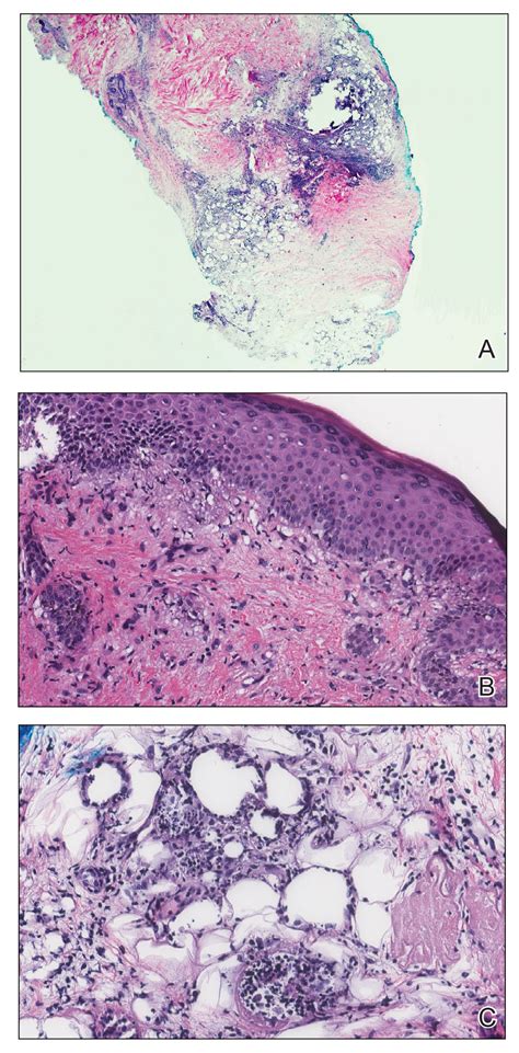 Juvenile Dermatomyositis Associated Panniculitis Mdedge