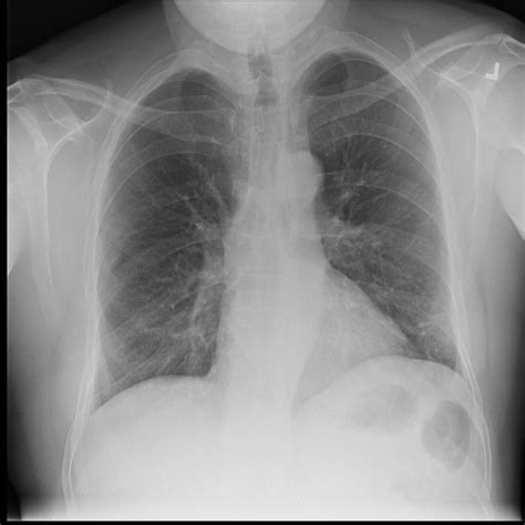 Lungs Classification Dataset And Pre Trained Model By East