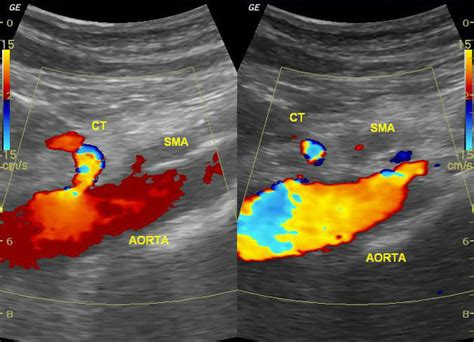 Inferior Mesenteric Artery Ultrasound