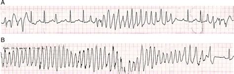 A Polymorphic Ventricular Tachycardia With Preceding Prolonged Qt A Polymorphic Ventricular Tachycardia With Preceding Prolonged Qt