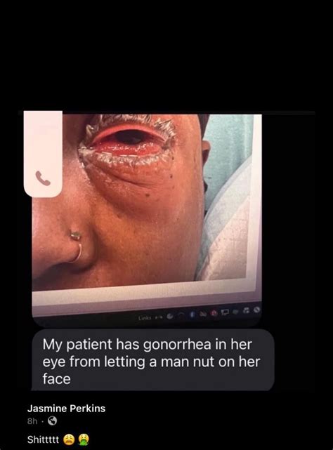 Gonorrhea Eye