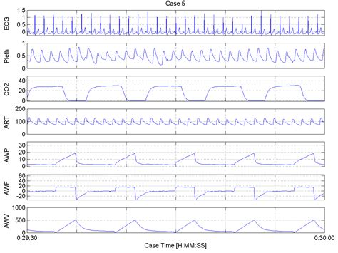 Case 5 Waveform Plots 30 Second Plots