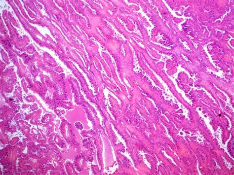 Pathology Outlines Papillary Oncocytic Variant