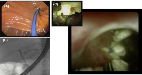 Direct Cholangioscopy Of Large Intrahepatic Duct Stone A Endoscopic