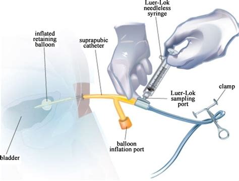 Catheter Induced Urinary Tract Infection Post Surgical Prevalence With