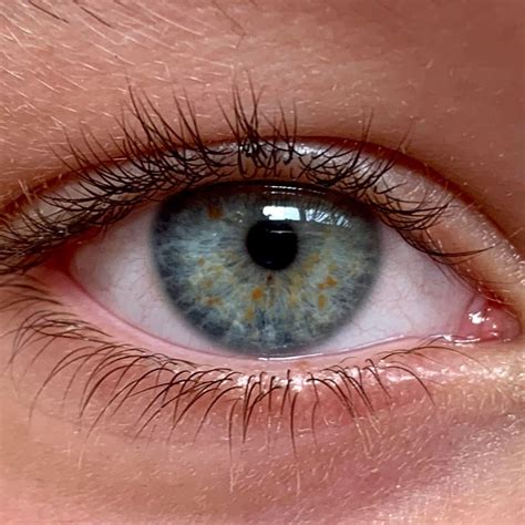 The Coffee Coloured Iris Nodules That Could Indicate A Rare Genetic Condition