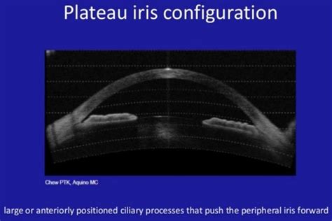 Glaucoma Lecture 3 Primary Angle Closure Disease Flashcards Quizlet