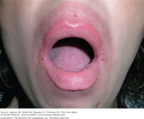 Angular Cheilitis Basicmedical Key