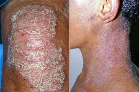Difference Between Eczema And Psoriasis In Ears At Nathan Oneill Blog