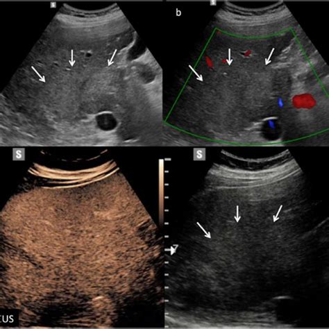 Ceus Li Rads 2 Probably Benign Regenerative Nodule In A 68 Year Old Download Scientific