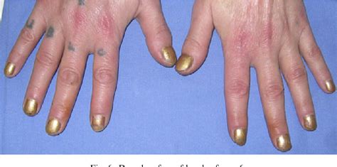 Pdf Pseudosclerodermatous Triad Of Perniosis Pulp Atrophy And