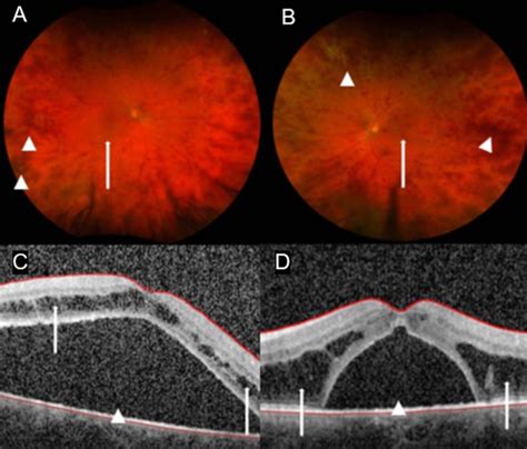 Full Article Hyperviscosity Syndrome Induced Bilateral Visual And