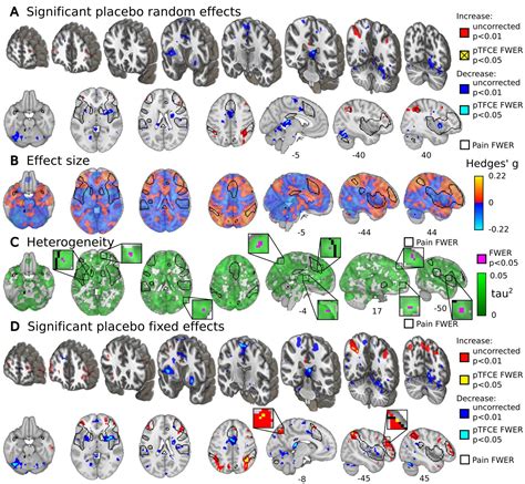 New Detailed Look At The Neuroscience Of Placebo Effects