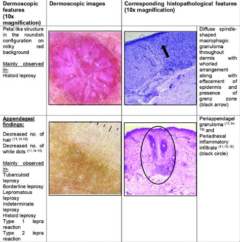 Comparison Of Various Dermoscopic Observations And Their Corresponding