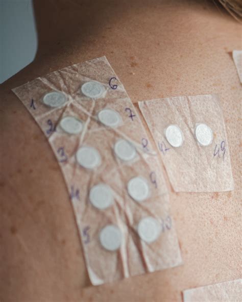 Patch Testing Southern Dermatology