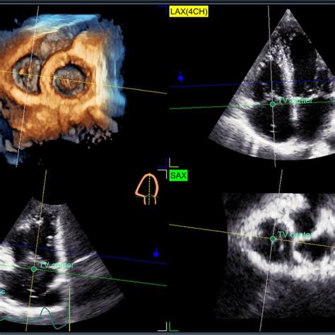 Automatic Slicing Of The Three Dimensional Echocardiography Dataset To Download Scientific