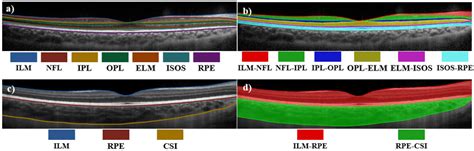 example of an oct image from the retinal dataset a b and choroidal download scientific
