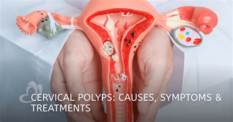 Cervical Polyp Causes Symptoms And Treatments Thomson Medical