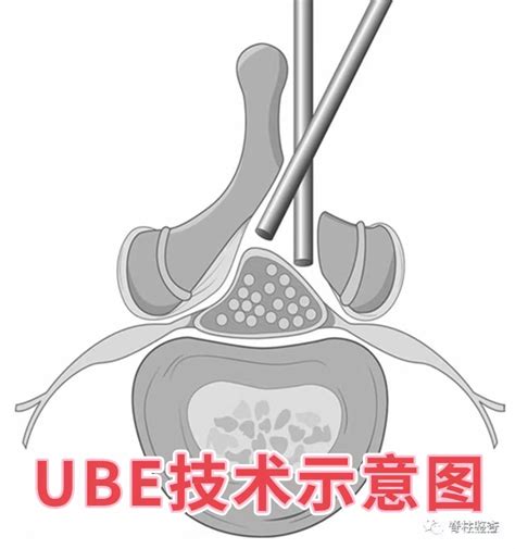 UBE技术让腰椎病人快速康复 西安凤城医院 官网 急救电话029 86530966