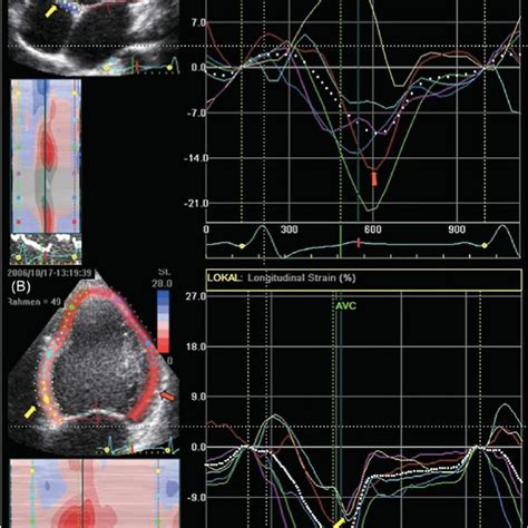 Longitudinal Two Dimensional Strain In The Apical Four Chamber View Of