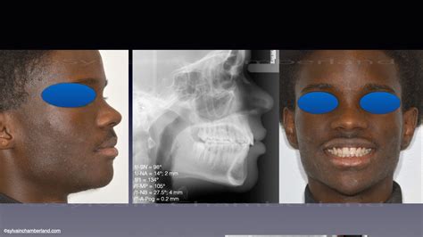 Bimaxillary Protrusion Facial Harmony Dr Sylvain Chamberland
