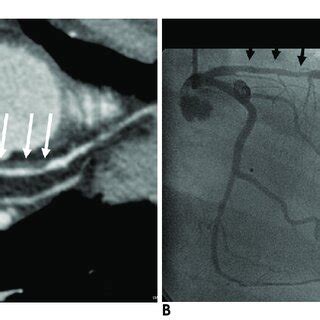 A 49 Year Old Female With Positive Treadmill Test A A Curved Download Scientific Diagram