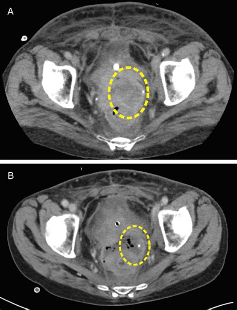 Vaginal Stump Recurrence A Before And B After The Administration Of