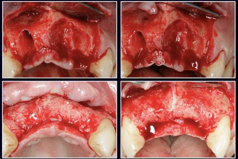 Preservation Of Alveolar Bone In Extraction Sockets School Of Dentistry