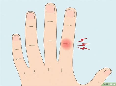 How To Know If Your Knuckle Is Broken Symptoms More