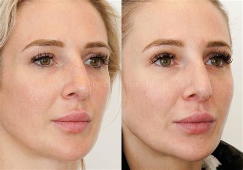 Cheek Fillers Before After Gallery Dr Cory Torgerson