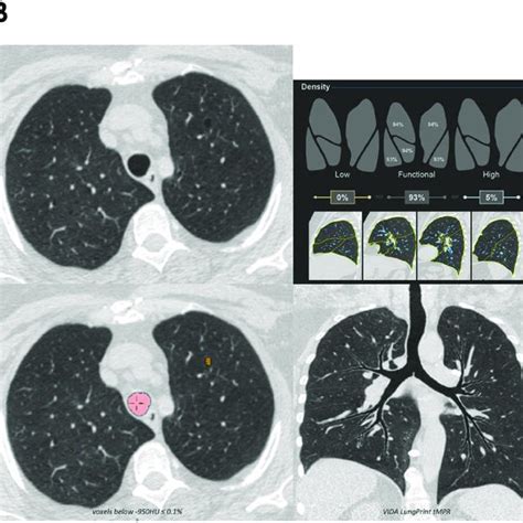 Examples Of Discordant Assessments A The Computed Tomography Was Download Scientific Diagram