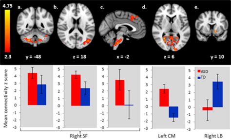 Areas Of Abnormal Intrinsic Functional Connectivity In Asd Panels Ac Download Scientific